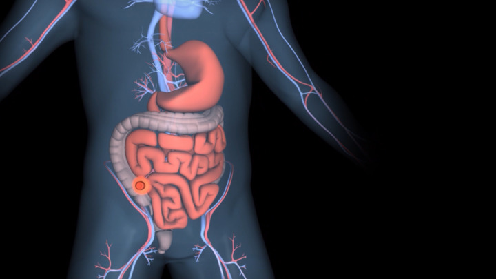 Video - ¿Qué es una Ileostomía? - HealthClips Online