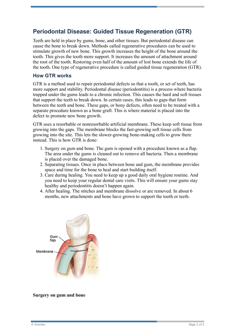 PDF - Periodontal Disease: Guided Tissue Regeneration (GTR ...