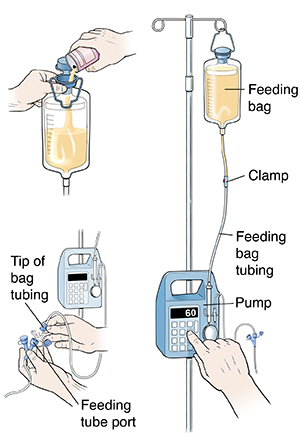 Text - Continuous Tube Feeding - HealthClips Online