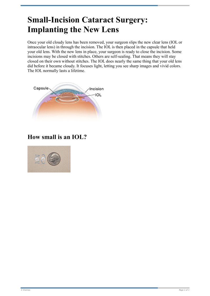 PDF - Small-Incision Cataract Surgery: Implanting the New Lens ...