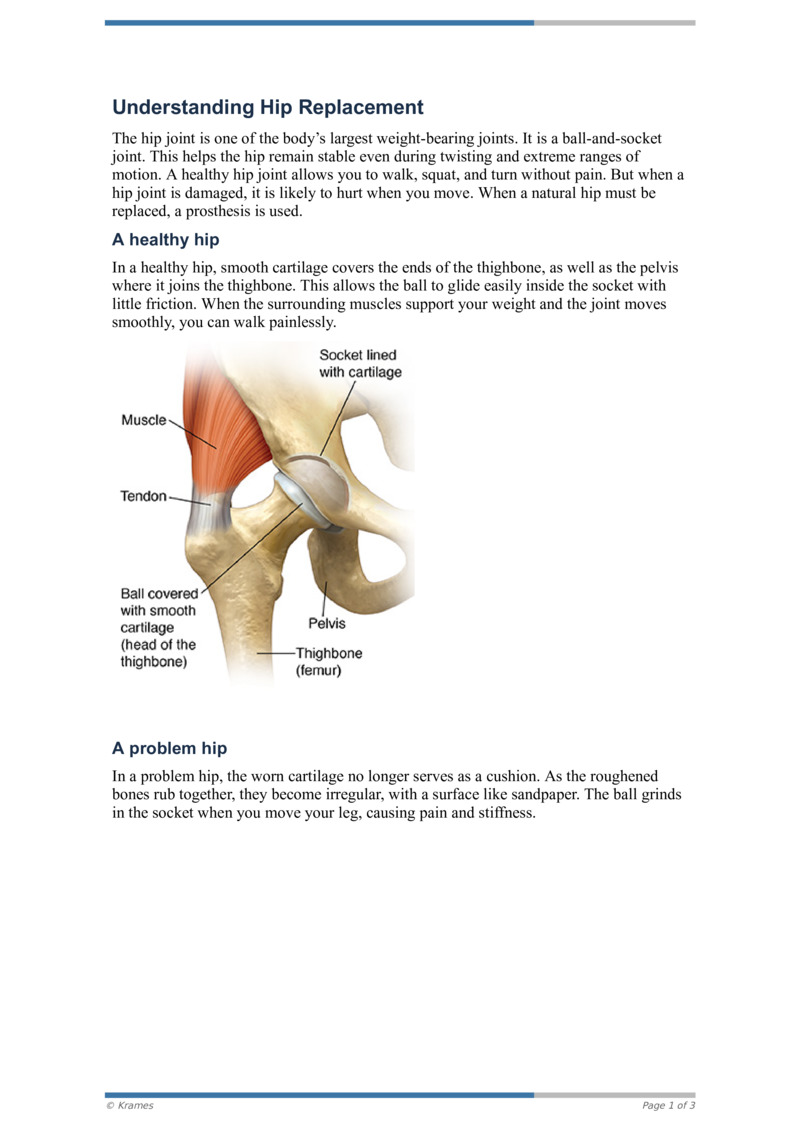 Pdf Understanding Hip Replacement Healthclips Online