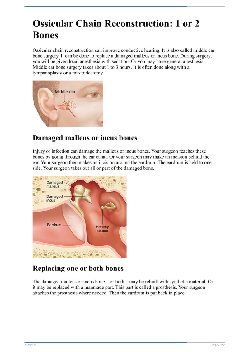 Text - Ossicular Chain Reconstruction: One or Two Bones - HealthClips Online
