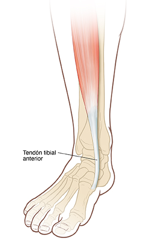 Texto - ¿Qué es la tendinitis del pie? - HealthClips Online