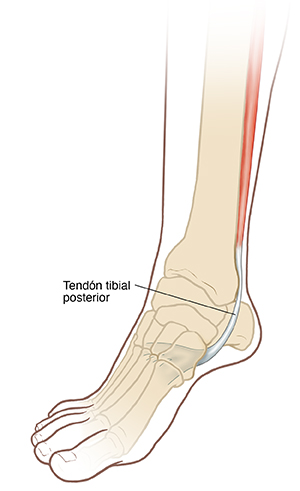 Texto - ¿Qué es la tendinitis del pie? - HealthClips Online