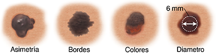 Texto - Pruebas para la detección del cáncer de piel - HealthClips Online