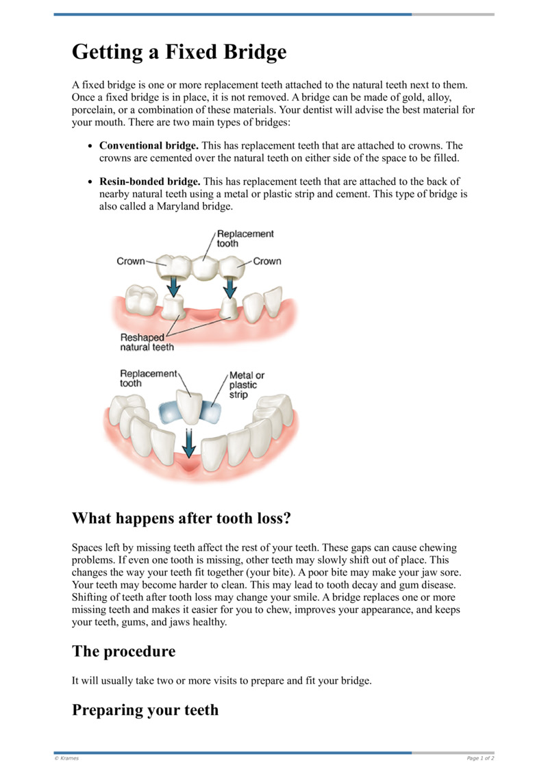 Text - Getting a Fixed Bridge - HealthClips Online