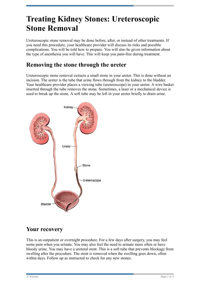 PDF - Treating Kidney Stones: Ureteroscopic Stone Removal - HealthClips ...