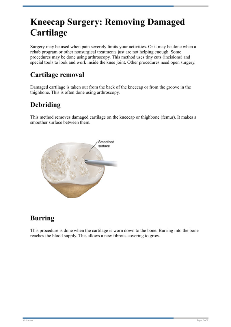 Text - Kneecap Surgery: Cartilage Removal - HealthClips Online