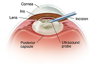 Text - Cataract Treatment: Removing the Cloudy Lens - HealthClips Online
