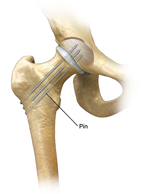 Text - Hip Fracture Surgery: Types - HealthClips Online