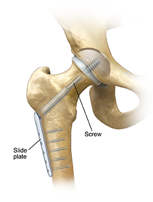 Text - Hip Fracture Surgery: Types - HealthClips Online