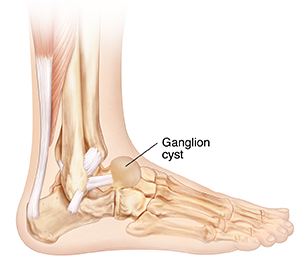 Text - Ganglion Cyst: Foot - HealthClips Online