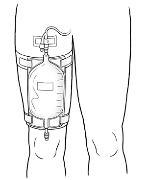 Text - Discharge Instructions: Caring for Your Leg Bag - HealthClips Online
