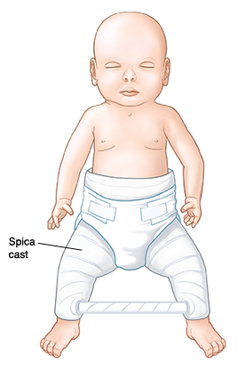 Text - When Your Child Needs a Spica Cast - HealthClips Online