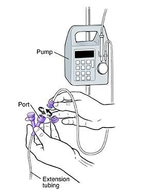 Text - Gastrostomy or Gastro-jejunum Tube: Flushing the Tube ...