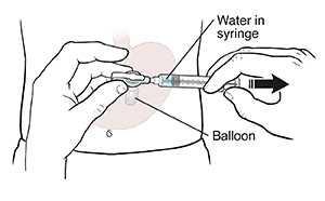 Text - Your Child's Gastrostomy Tube: Checking the Balloon ...