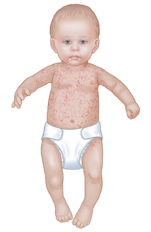 Text - When Your Child Has Roseola - HealthClips Online