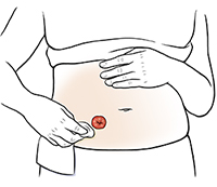 Text - Urostomy: Changing Your Pouch - HealthClips Online
