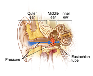 Text - Understanding Ear Barotrauma - HealthClips Online