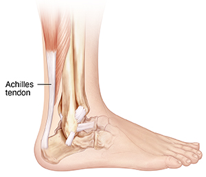 Text - Understanding Achilles Tendonitis - HealthClips Online