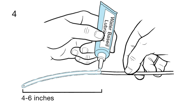 Video - Step-by-Step: Inserting a Reusable Catheter (Man) - HealthClips ...