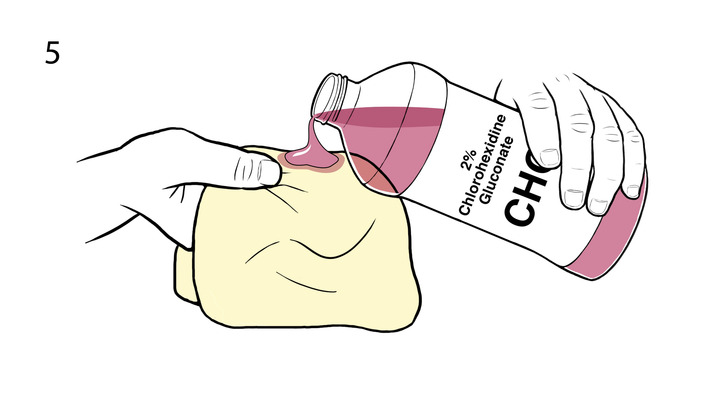 Video - Using Chlorhexidine Gluconate (CHG) Liquid Soap Before Surgery ...