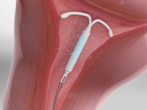 Video - Hormonal IUD (Intrauterine Device) - HealthClips Online