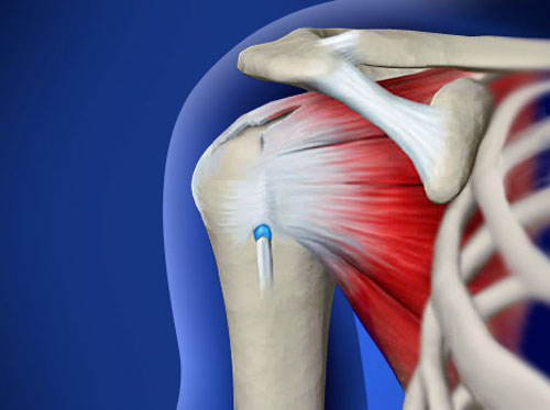 Video - Mini-Open Rotator Cuff Repair - HealthClips Online