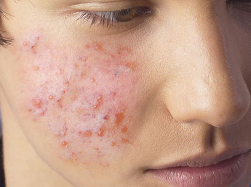 Video - Acne - HealthClips Online