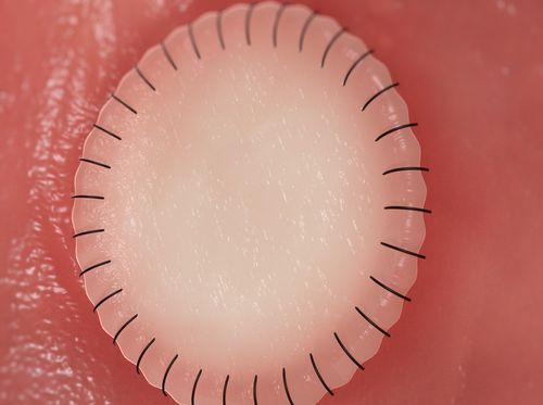 Video - Atrial Septal Defect Repair (Open Surgery Method) - HealthClips ...