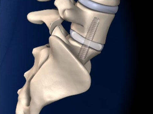 Video - AxiaLIF® (Axial Lumbar Interbody Fusion) - HealthClips Online