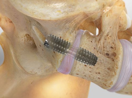 Video - AxiaLIF (fusión lumbar intersomática axial) - HealthClips Online