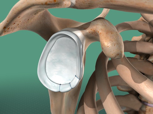 Video - Bankart Repair - HealthClips Online