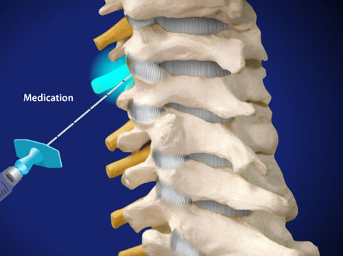 Video - Selective Nerve Root Block (SNRB) in the Cervical Spine ...