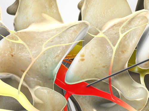 Video - Selective Nerve Root Block (SNRB) in the Cervical Spine ...