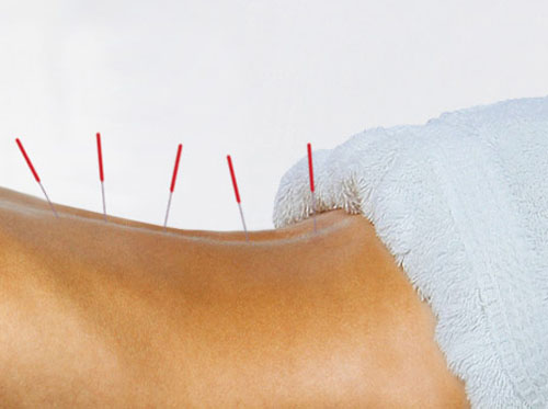 Video - Chinese Acupuncture for Lower Back Pain - HealthClips Online