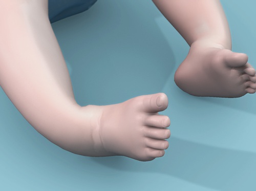 Video - Clubfoot (Talipes Equinovarus) - HealthClips Online
