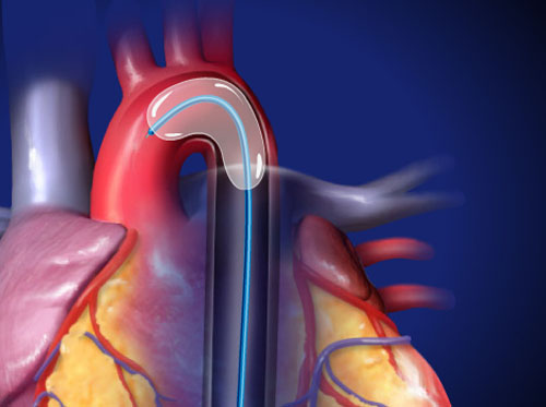 Video - Aortic Coarctation Balloon Angioplasty - HealthClips Online