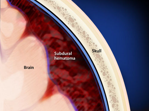 Video - Craniotomy for Subdural Hematoma - HealthClips Online