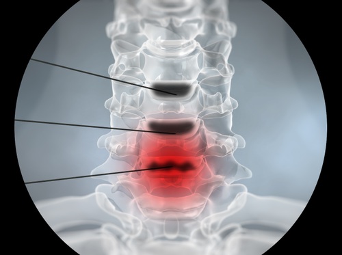 Video - Discography (Cervical) - HealthClips Online