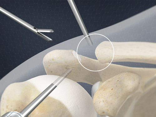 Video - Distal Clavicle Excision (Arthroscopic Method) - HealthClips Online