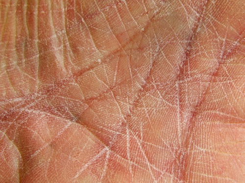 Video - Dry Skin - HealthClips Online