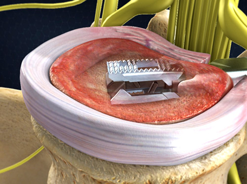 Video - Endoscopic-Assisted Lumbar Interbody Fusion (Transforaminal ...