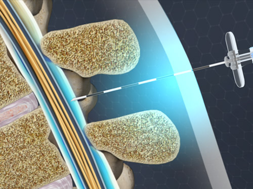 Video - Epidural for Cancer - HealthClips Online