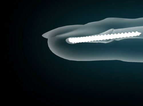 Video - Finger Joint Fusion (of the DIP Joint) - HealthClips Online