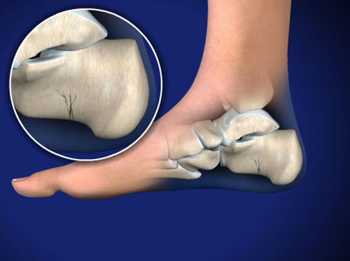 Video - Fractura del hueso del talón (calcáneo) - HealthClips Online