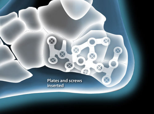 Video - Calcaneal Fracture Fixation (Open Reduction and Internal ...