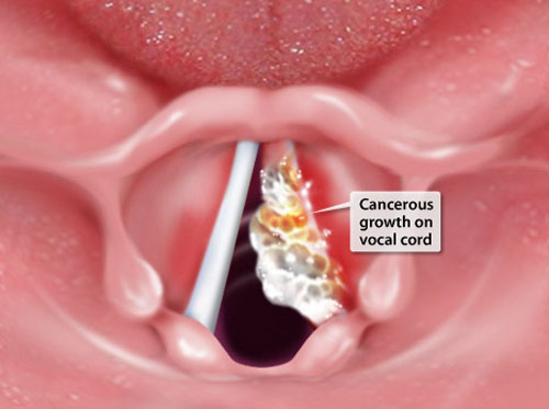 Video - Cáncer de hipofaringe - HealthClips Online