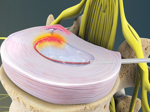 Video - Intradiscal Electrothermal Therapy (IDET) - HealthClips Online