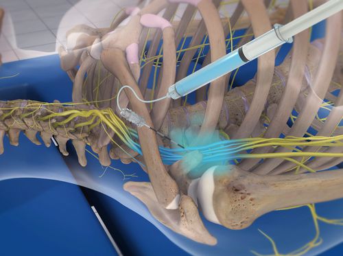 Ultrasoundguided Infraclavicular Brachial Plexus Block